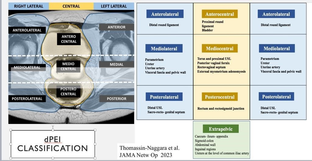 A la recherche de l’endométriose, le nouveau blockbuster des JFR en 3 dimensions | SFR